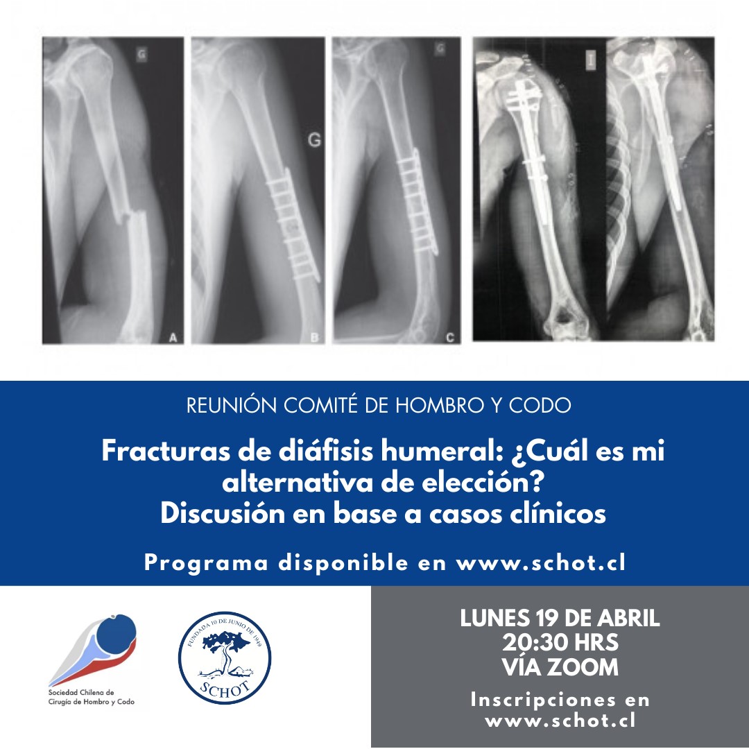 Manejo de Fracturas diafisiarias de húmero – SCHOT